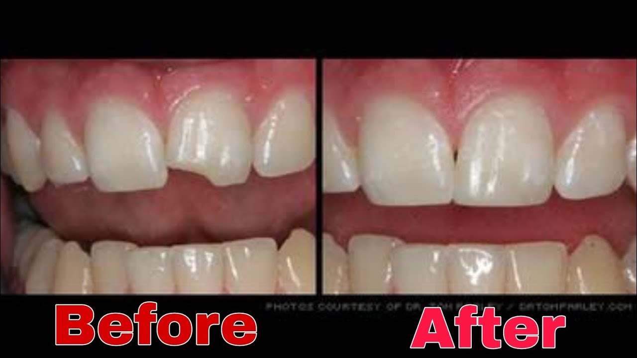 Porcelain Jacket Crown- Tooth preparation and porcelain build-up - YouTube