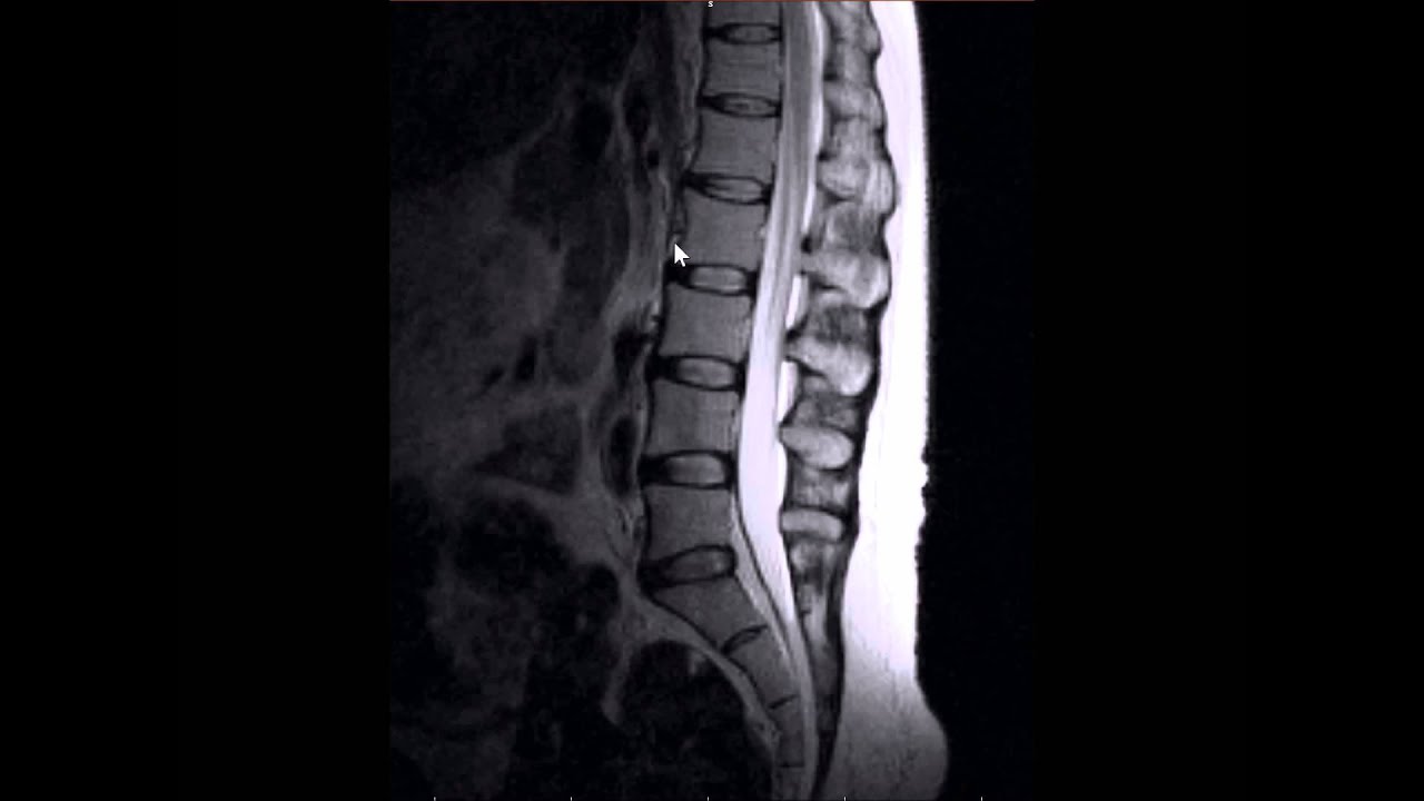 Lumbar Disc Herniation Mri The Radiology Assistant : Lumbar Disc