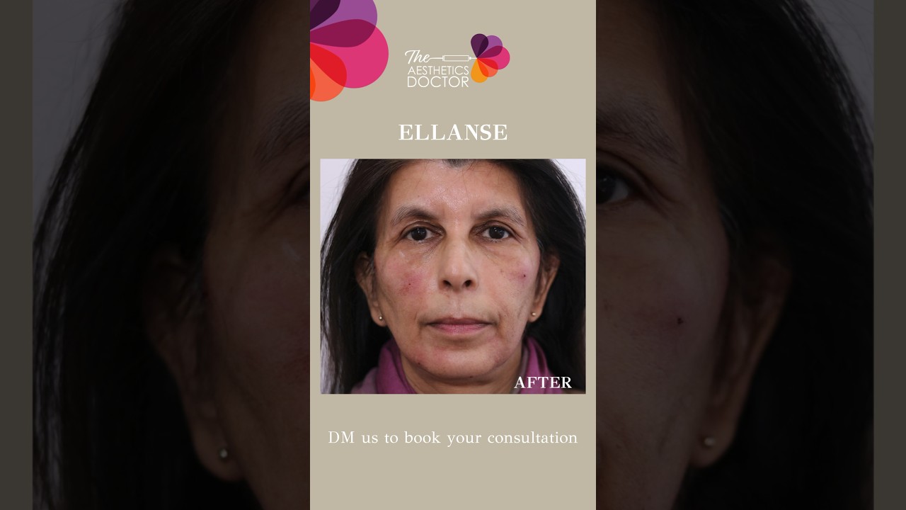 Ellanse