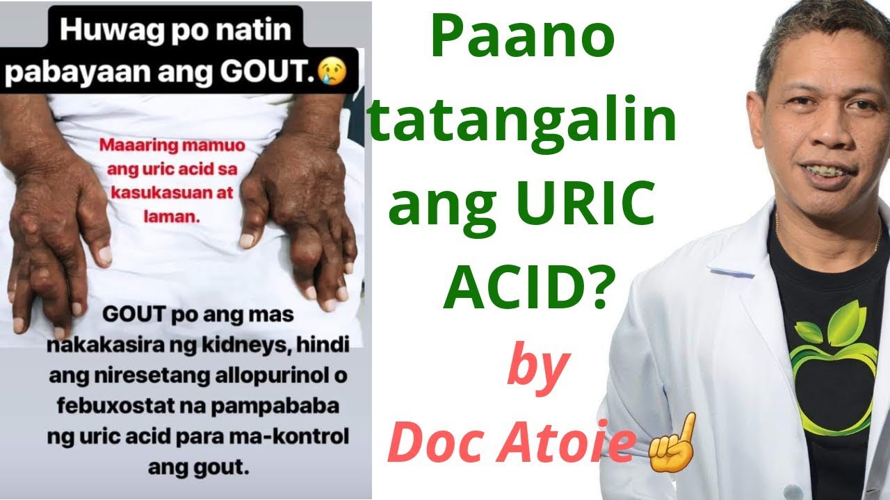 URIC ACID Paano pagagalingin by Doc Atoie Arboleda 💛 - YouTube