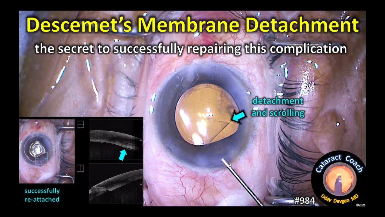 Descemet's Membrane Detachment during Cataract Surgery - YouTube