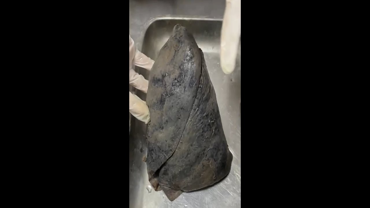 LUNG ANATOMY(CADAVER)| RIGHT AND LEFT LUNG ANATOMICAL FEATURES|RIGHT ...