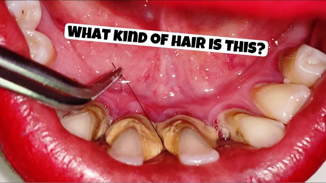 I found hair between the tartar of this woman's teeth. - YouTube
