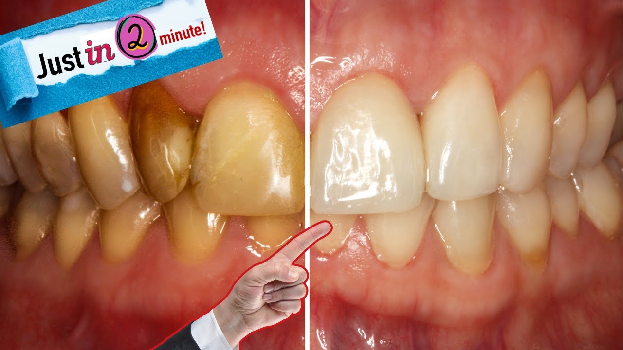 Teeth Whitening At Home In Just 2 Minutes - How To Whiten Teeth At Home ...