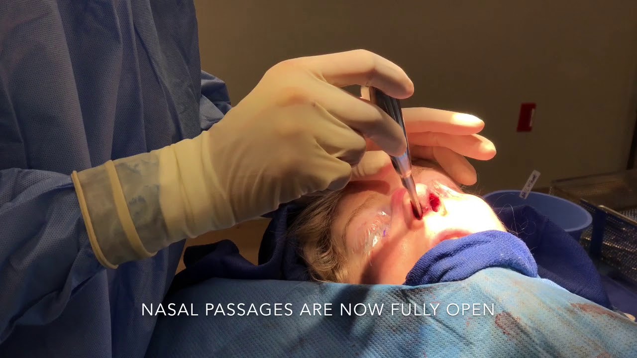 Results of septoplasty - YouTube