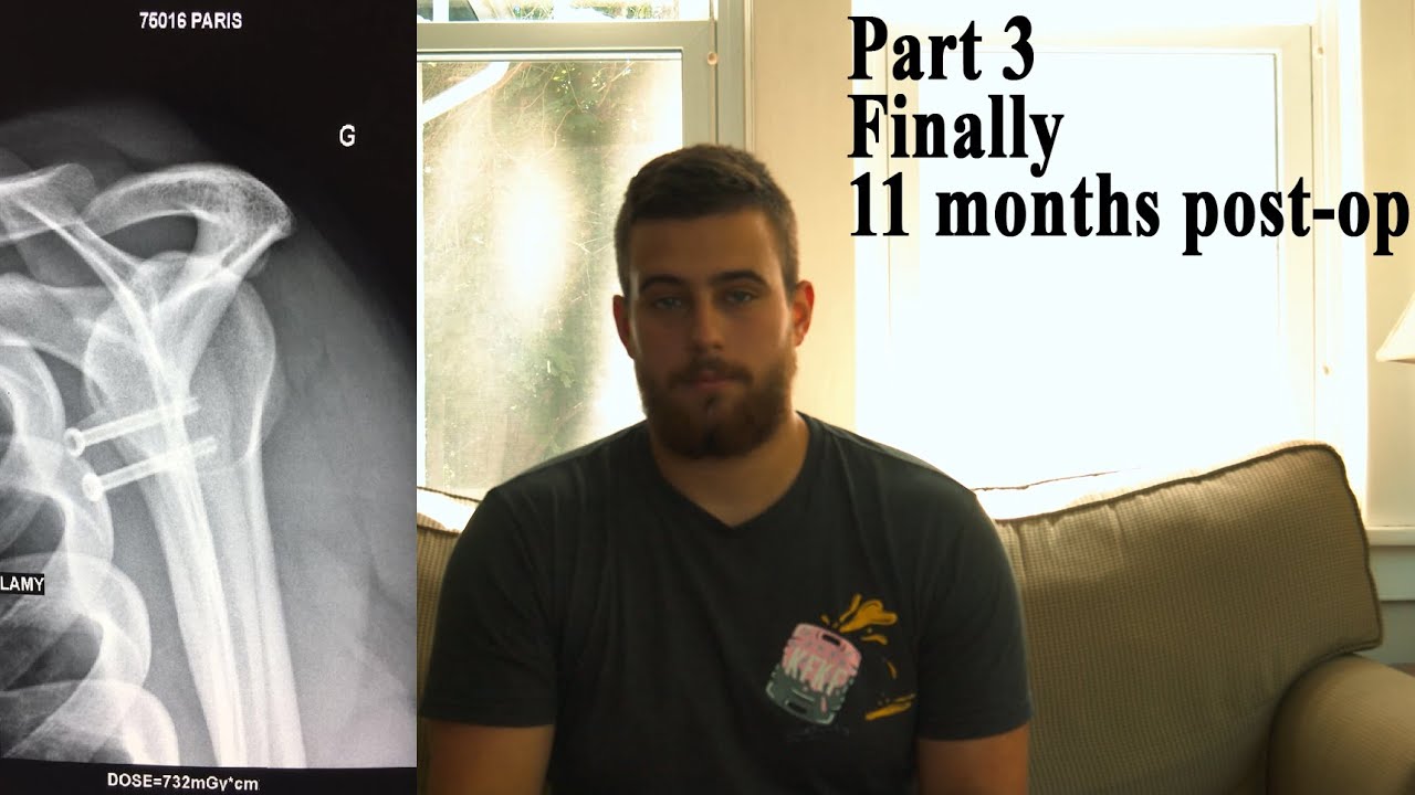 Latarjet Shoulder Surgery experience|Rugby Injury Part 3 - YouTube