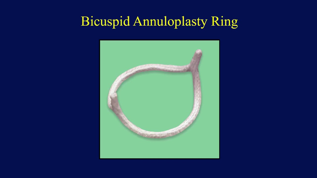 Bicuspid Ring Annuloplasty and Leaflet Reconstruction After Failed ...