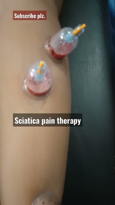 Sciatica pain therapy/ Cupping for sciatica pain / Hijama for Sciatica pain / Nerve pain therapy ...