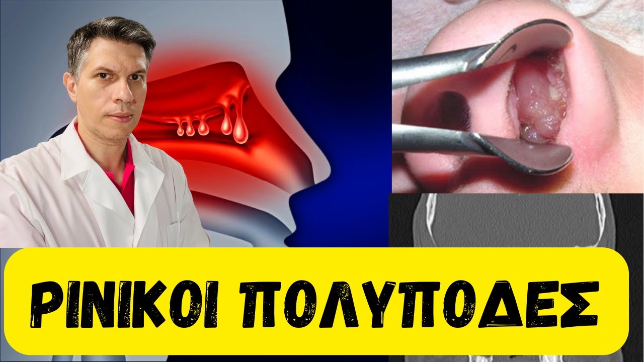 Αντιμετωπίζονται οι ΠΟΛΥΠΟΔΕΣ ΣΤΗ ΜΥΤΗ; (ΡΙΝΙΚΟΙ ΠΟΛΥΠΟΔΕΣ) - YouTube