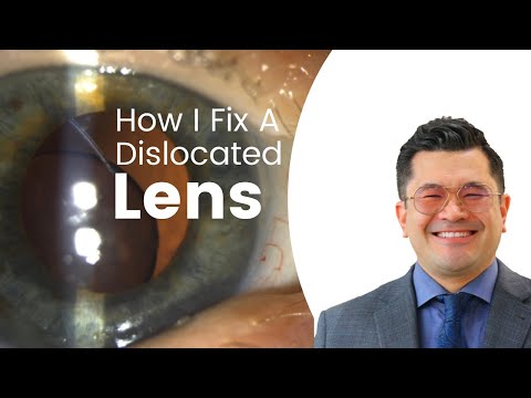 Can A Dislocated Lens After Cataract Surgery Be Seen