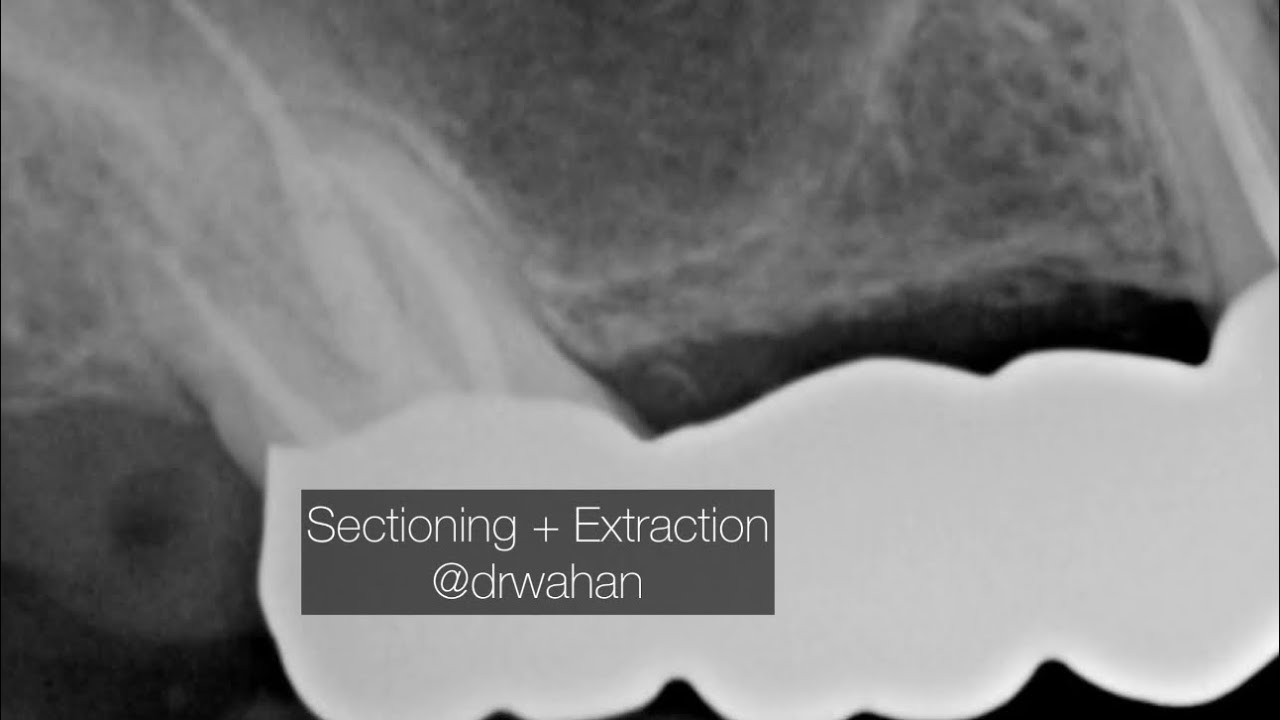 Sectioning an Upper Molar Step by Step - YouTube