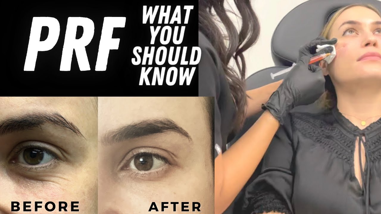 CRAZY RESULTS with PRF - a MUST for aging under-eyes - YouTube