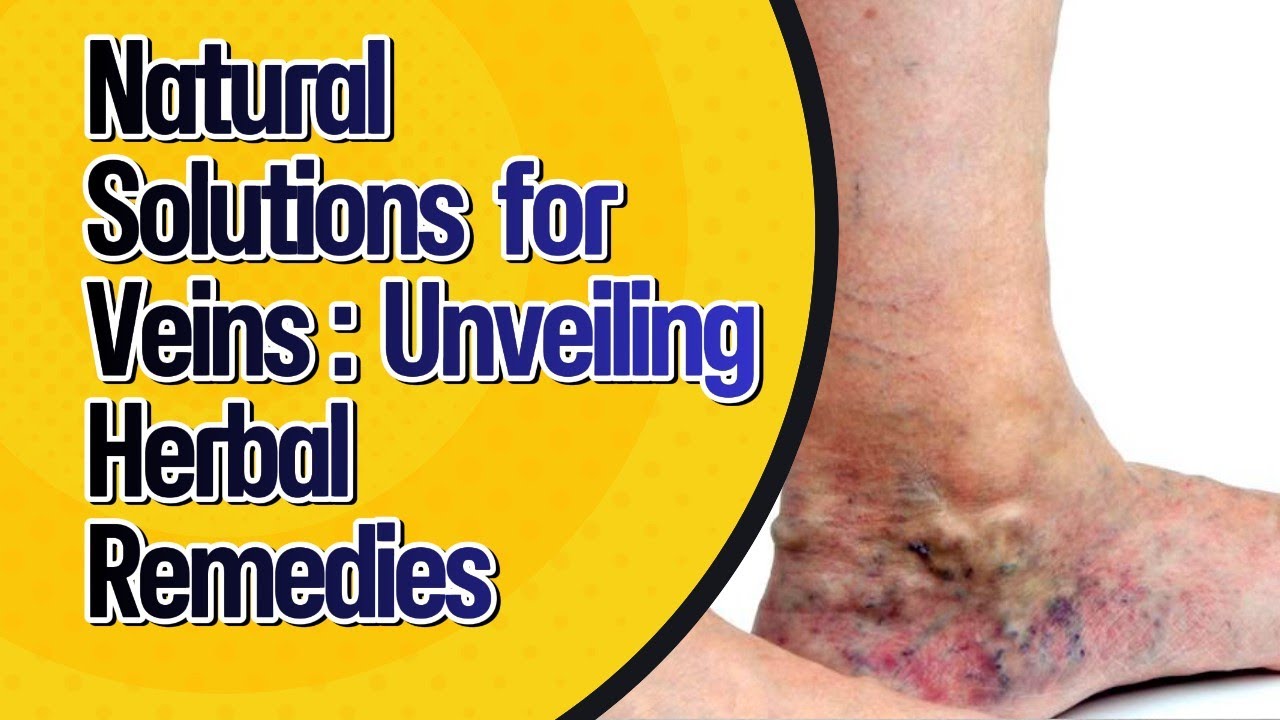 Natural Solutions for Varicose Veins: Unveiling Herbal Remedies - YouTube