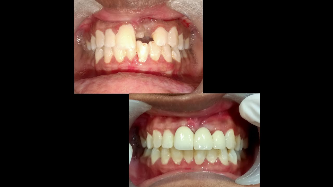 Missing front tooth of an young girl!!!Regained her smile and ...