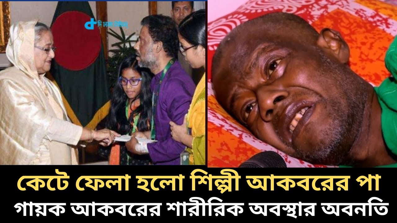 চেষ্টা করেও বাঁচানো গেল না শিল্পী আকবরের পা। শেষমেষ কেটেই ফেলতে হলো ...