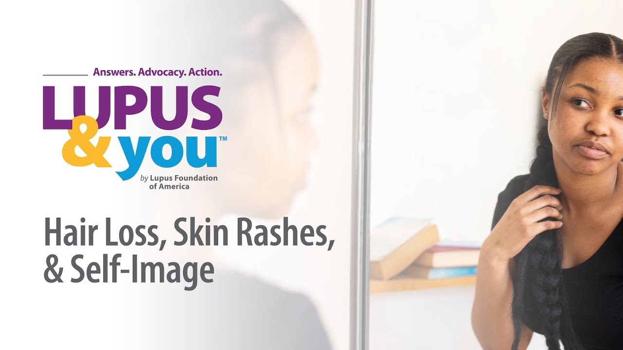 Lupus & You : Hair Loss, Skin Rashes, and Self-Image - YouTube