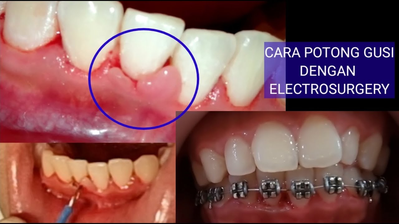 BEGINI CARA POTONG GUSI DENGAN ELECTROSURGERY UNTUK KEPERLUAN ORTHO ...