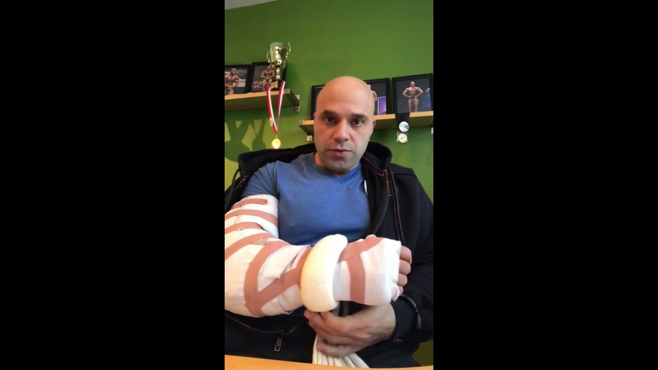 Week 1 - Recovery Following Distal Bicep Tendon Tear Surgery - YouTube