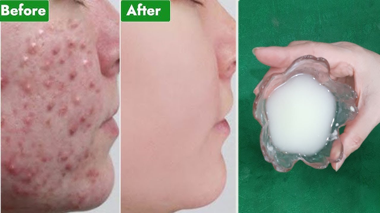 I applied this on my Small Bumps, Pimples, Whiteheads & Acne - Got ...