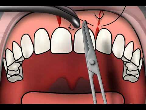 Dental Stitching - YouTube