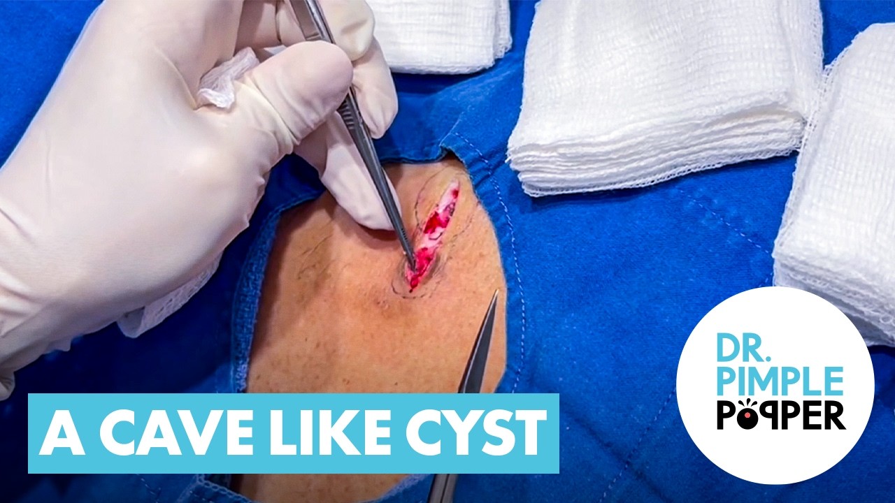 Dr Pimple Popper Explores a Cave Like Cyst! - YouTube