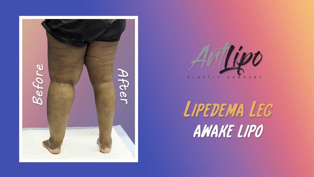 Lipedema Leg Liposuction | Cankles & Knees Complex | | Lipo 360 ...