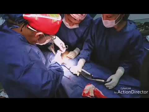 Apendicectomia Abierta - YouTube