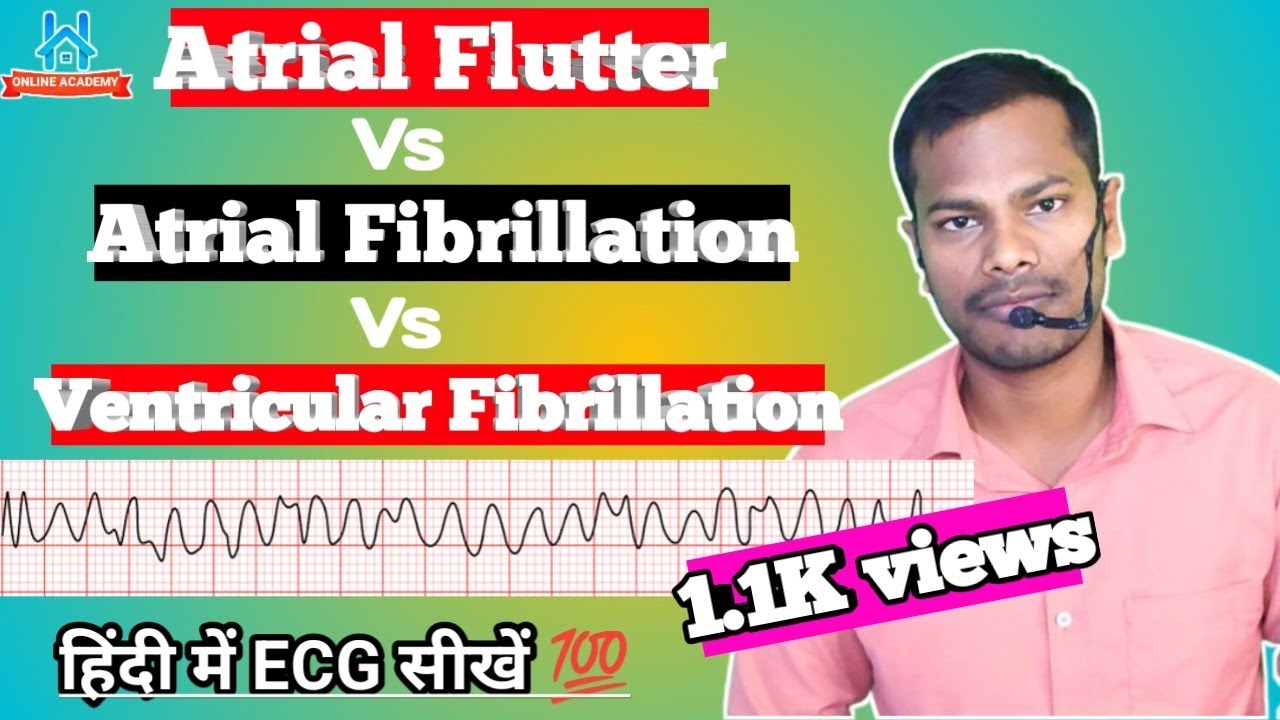 AF | atrial flutter | atrial fibrillation | ventricular fibrillation ...