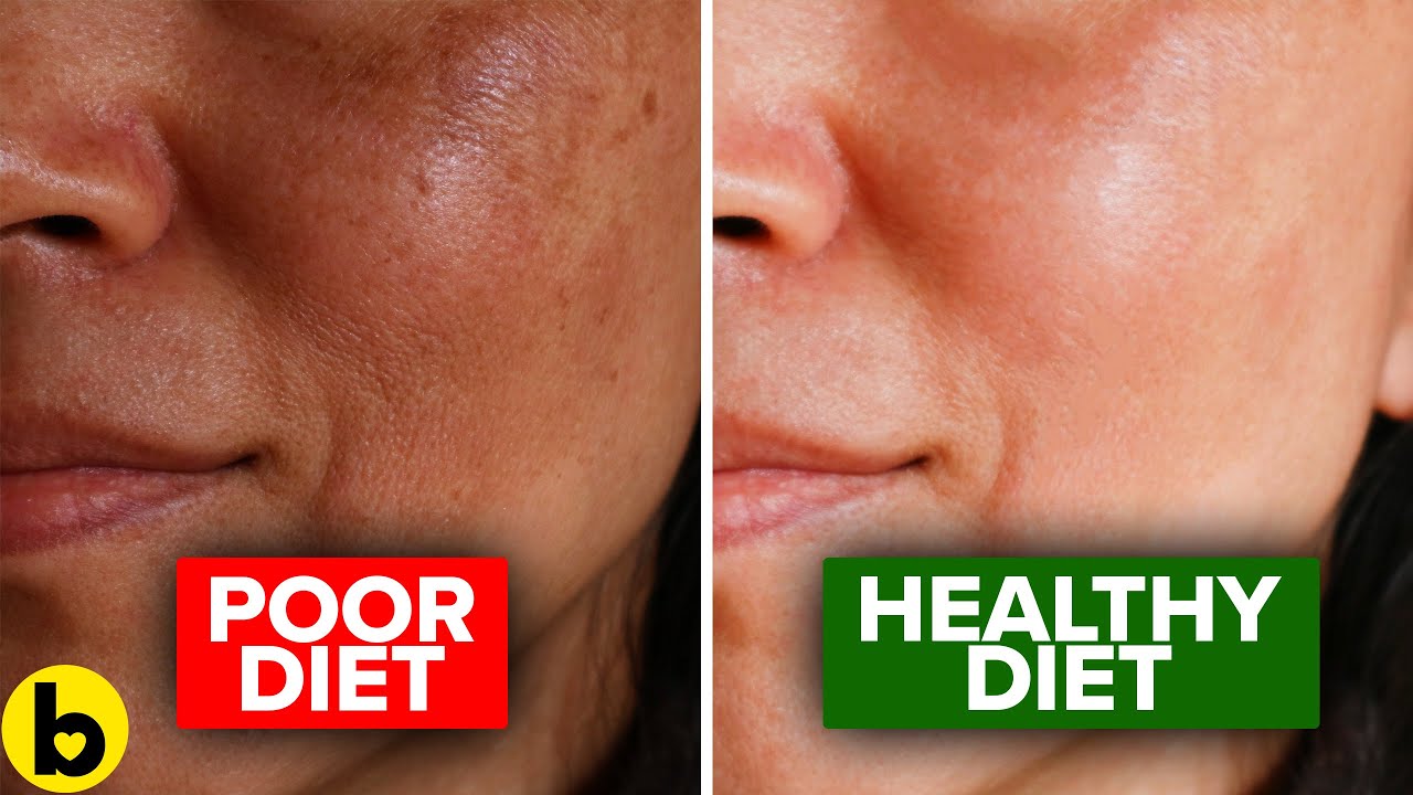 The Cause Of Skin Pigmentation And How To Avoid It - YouTube
