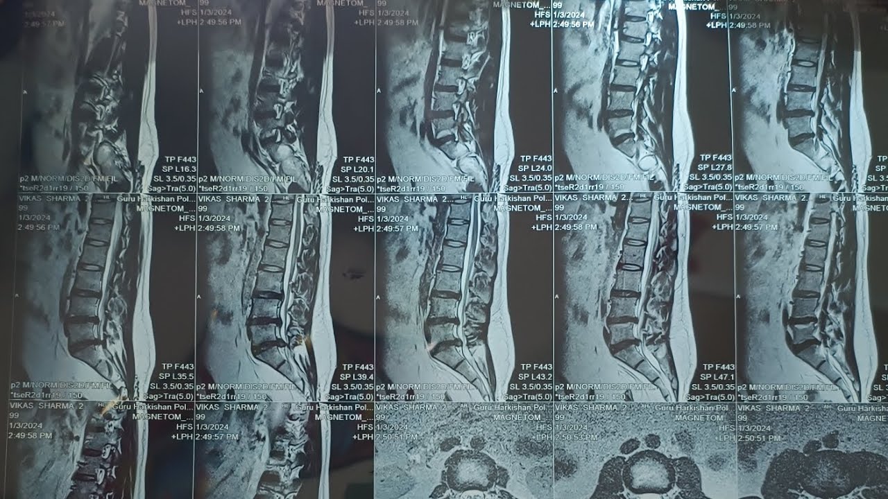 Always be happy L4 L5 S1 Disc bulge,Disc decompression, lower back ...