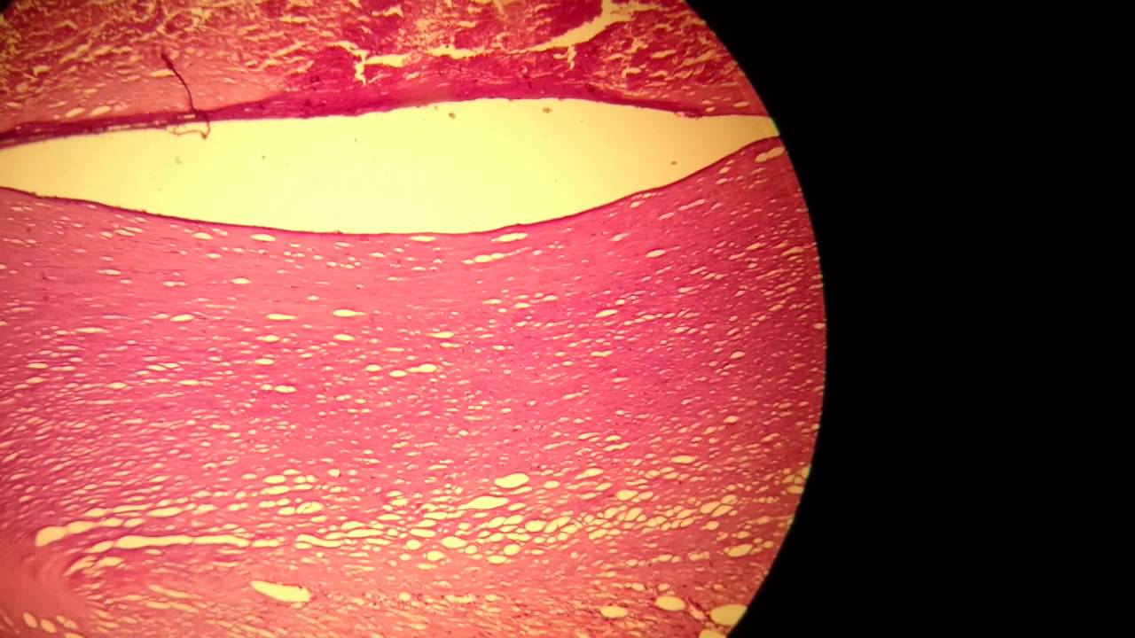 2- Myocardial infarction - Coagulative necrosis - Heart - YouTube