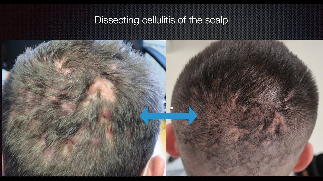 Scalp Cellulitis