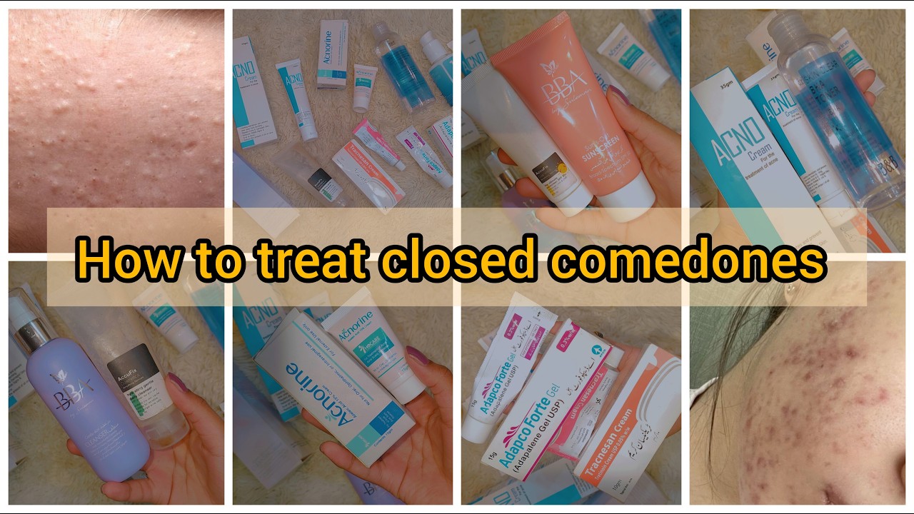 Medicated Skincare | how to treat closed comedones, acne, pimples ...