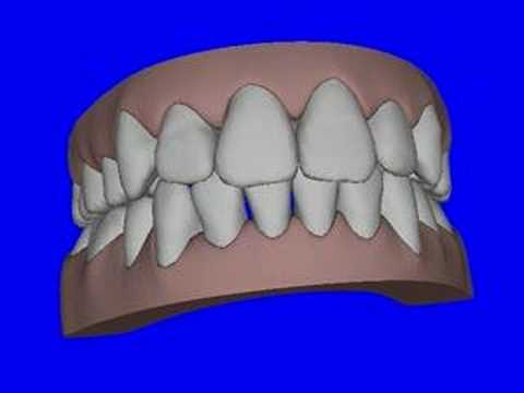 Teeth with Overbite of 100% - YouTube