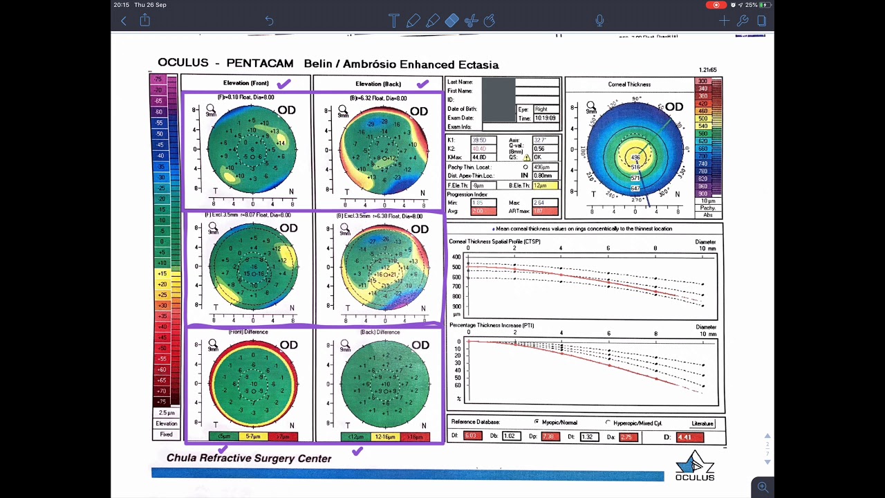 [Tutorial] Basic Corneal Tomography (Pentacam) Reading for Beginner in ...