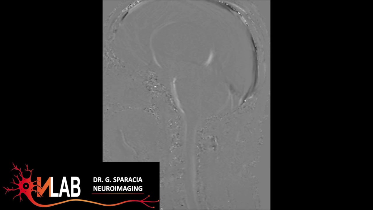 3D Cine MR CSF Flow Imaging - YouTube