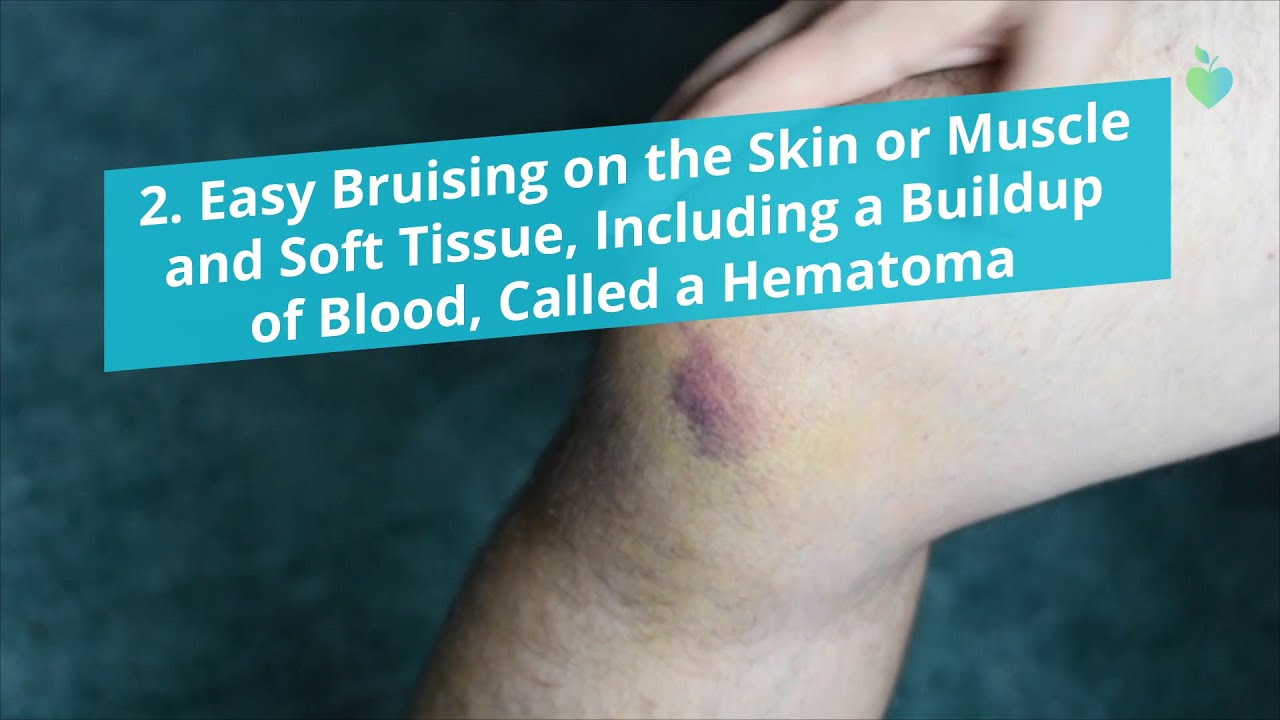 9 Symptoms of Hemophilia A - YouTube