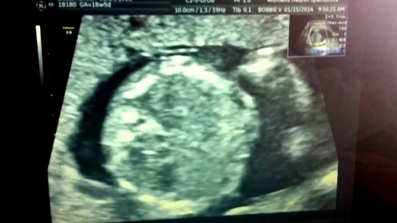 Anatomy Scan at 18 weeks and 5 days pregnant!! - YouTube