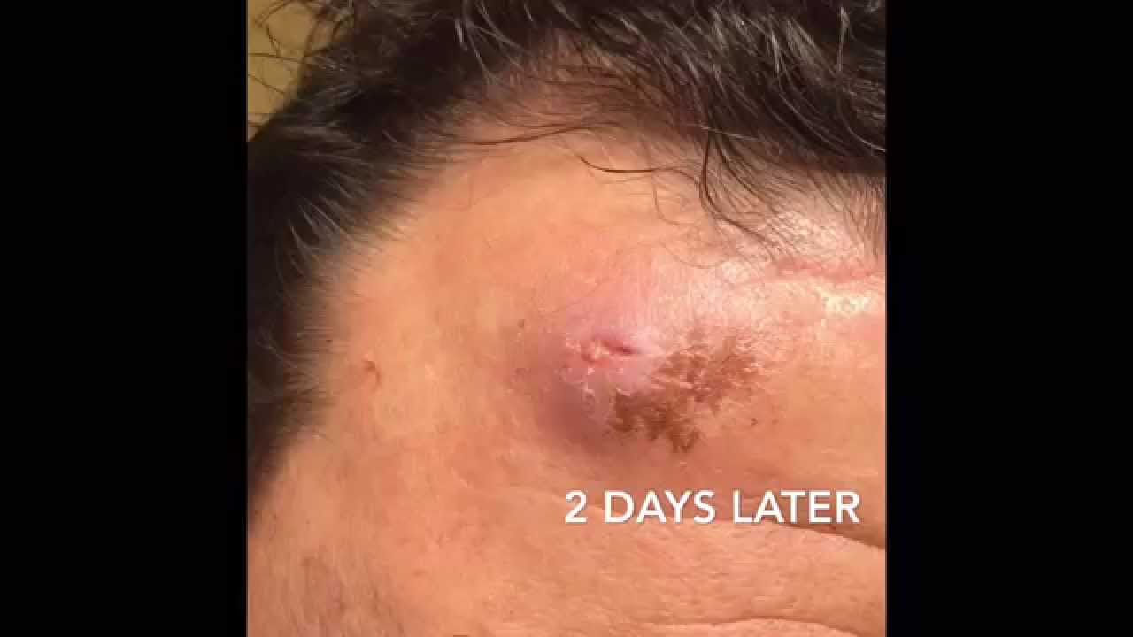 Spider Bite in Clearwater, Fla. - Coby's Termite and Pest Control - YouTube