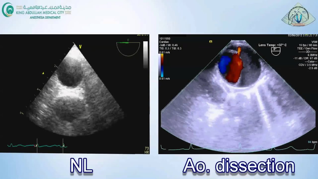 039 Aortic Dissection TEE KAMC - YouTube