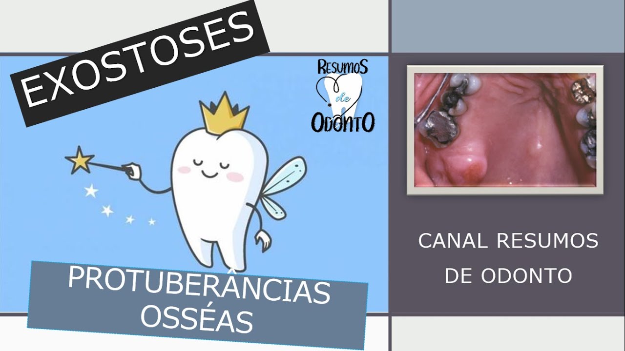 Exostose | Resumos de Odonto - YouTube