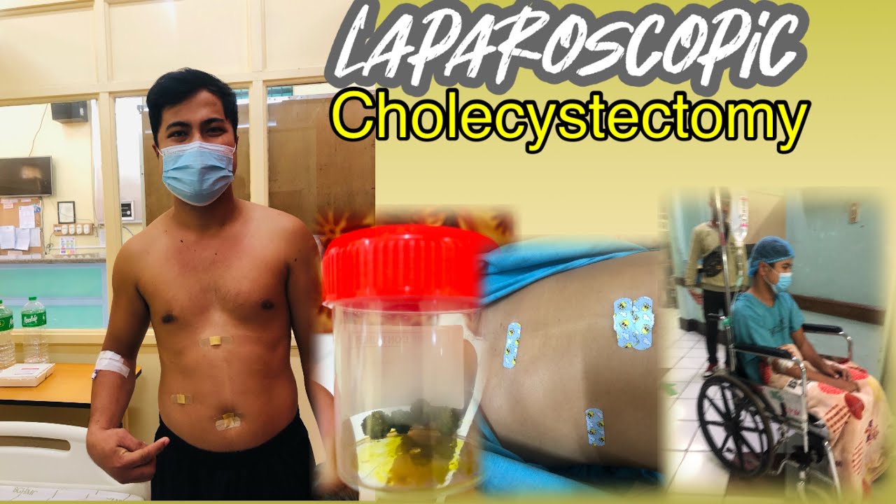 CHOLELITHIASIS | BATO SA APDO | Paano nakukuha at ano ang solusyon | # ...