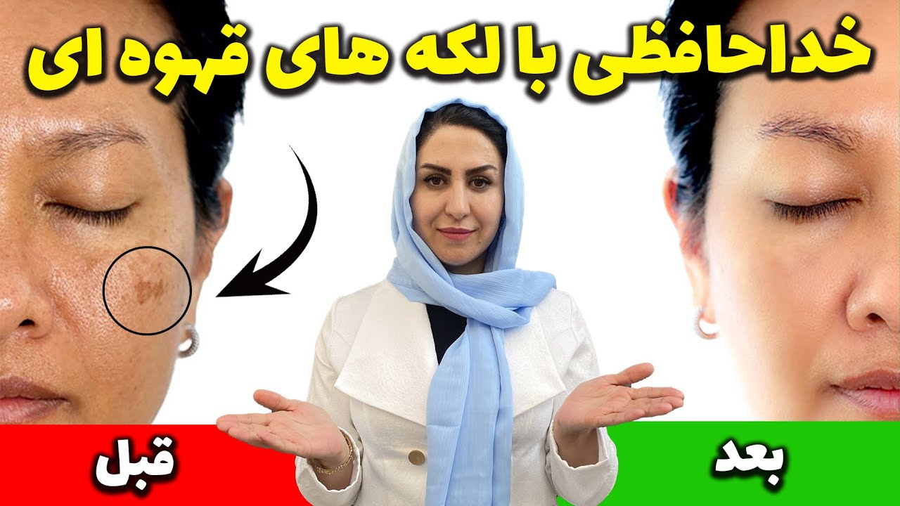 درمان همیشگی لکه های قهوه ای و سفید روی صورت، دست، گردن و بدن پوستی