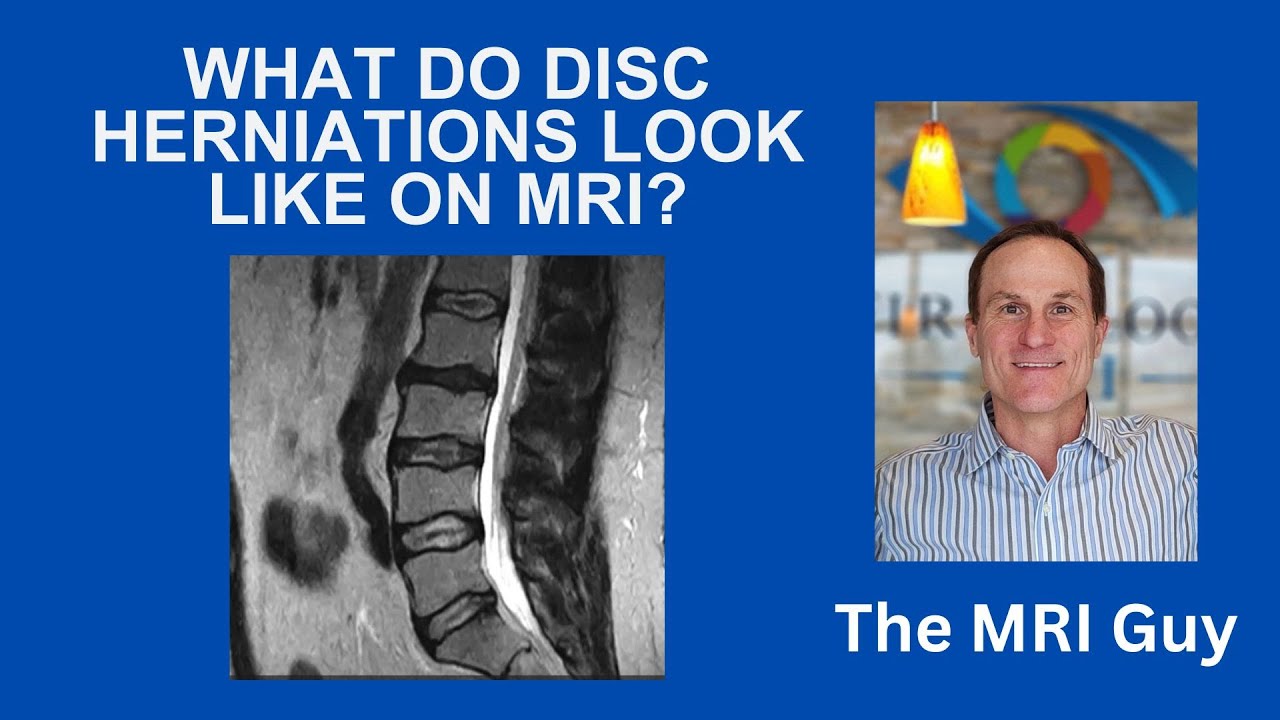 3 disc herniations on MRI - YouTube