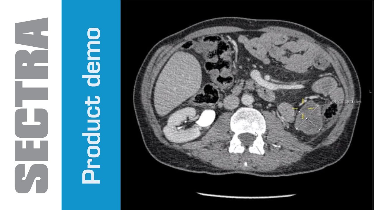 Sectra Lesion Tracking - YouTube