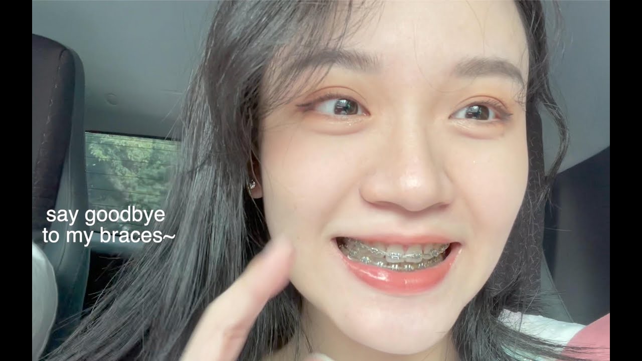 摘牙套vlog｜终于解放的自由人｜Say goodbye to my braces - YouTube