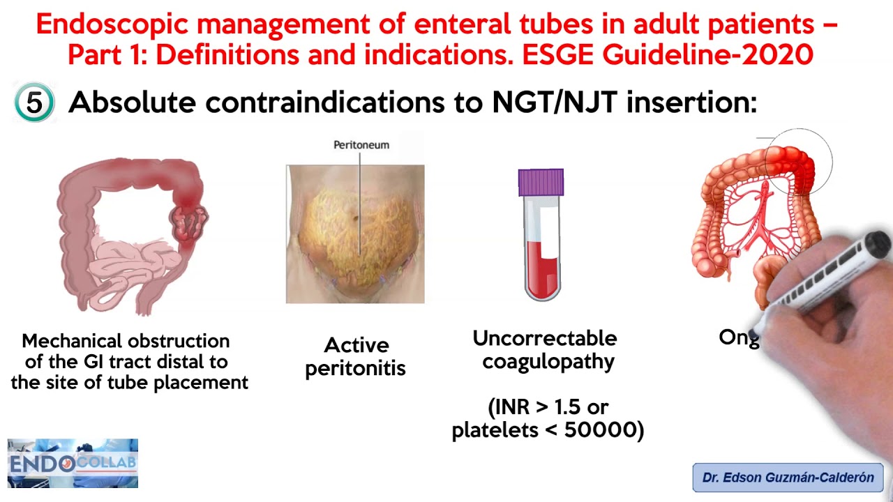 Endoscopic management of enteral tubes in adult patients –Part 1 ...