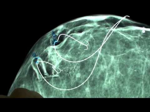 Tips and Pitfalls -  Case I -  J wire for Microcalcifications (10m04)