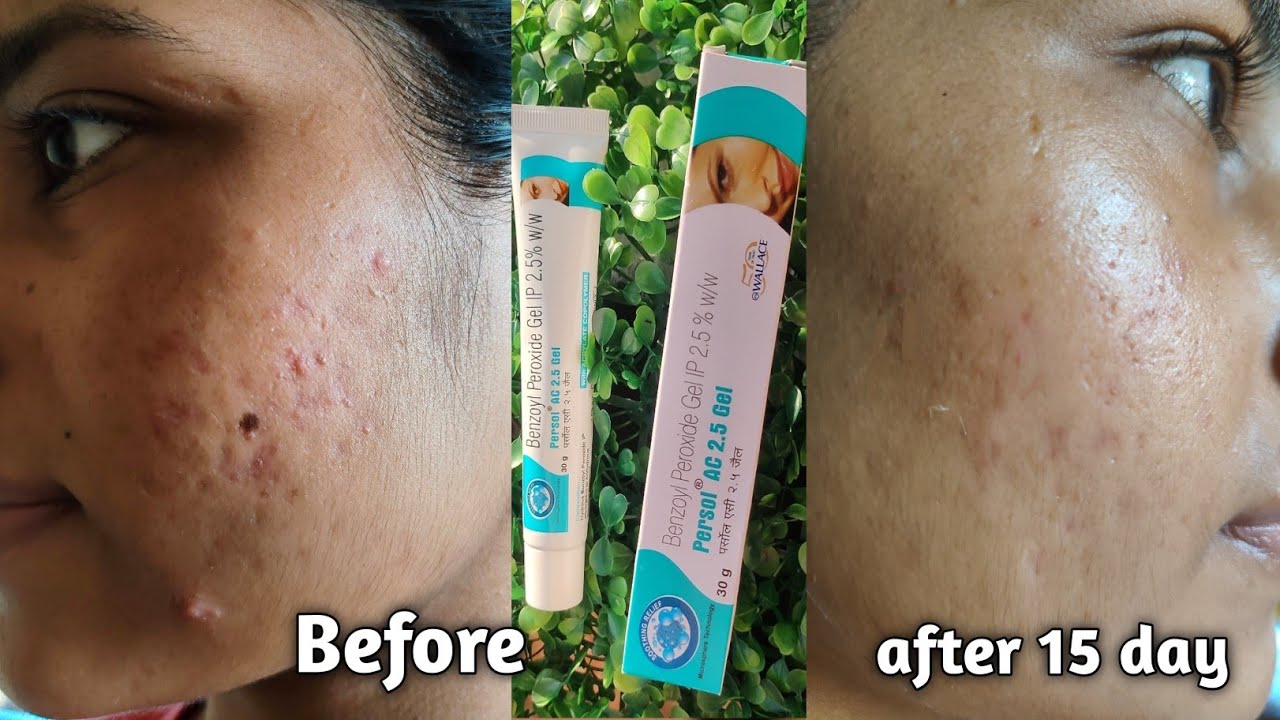 Dermatologist Recommend Best Cream for Acne Pimple, Acne.Benzoyl ...