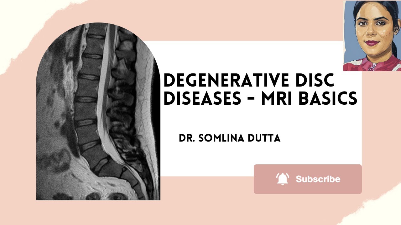 Basics of Lumbo-Sacral Degenerative Disc Diseases MRI | Radiology ...